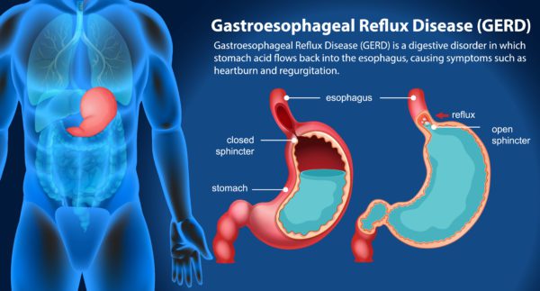 Dr. Rachel's Guide to Managing GERD & IBS; Diet, Health Tips and More ...